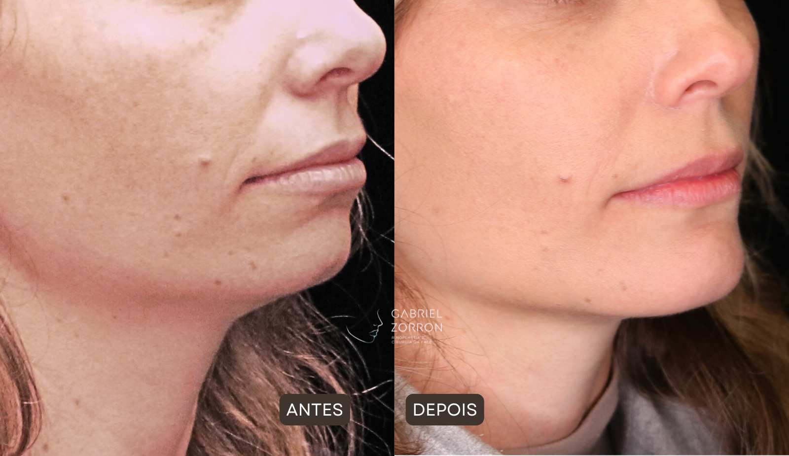 Guia da Mentoplastia: tudo sobre a harmonização no queixo